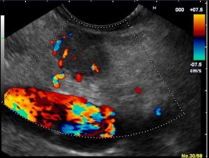 Cecal sessile polyp (LST-G) – GastroCloud