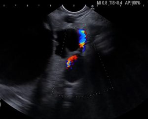 Polip plat elevat (LST-NG) colon descendent – GastroCloud