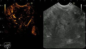 GAVE syndrome – GastroCloud