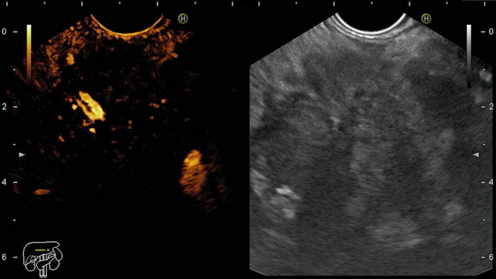 Let’s learn contrast EUS #01: hypoenhancing pancreatic adenocarcinoma ...