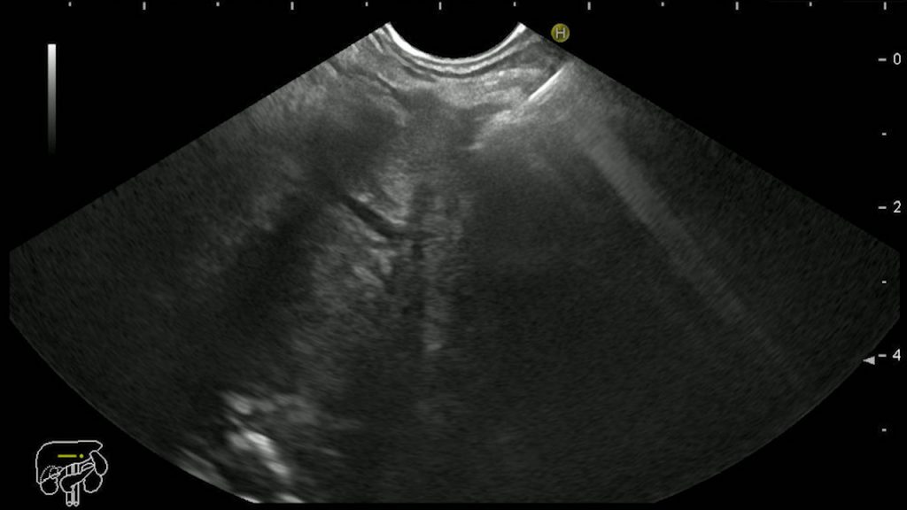 Let’s learn contrast EUS #01: hypoenhancing pancreatic adenocarcinoma ...