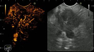Cecal sessile polyp (LST-G) – GastroCloud
