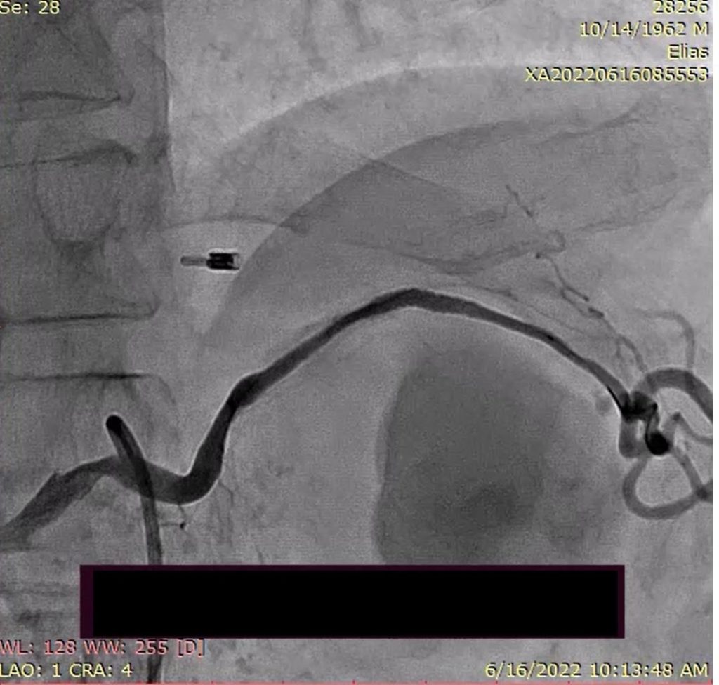 Pancreatic pseudoaneurysm – GastroCloud