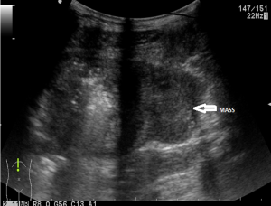 Cecal sessile polyp (LST-G) – GastroCloud