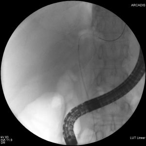 GAVE syndrome – GastroCloud