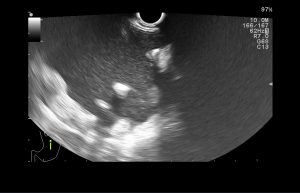 Cecal sessile polyp (LST-G) – GastroCloud