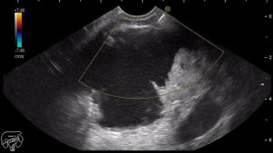 Cecal sessile polyp (LST-G) – GastroCloud