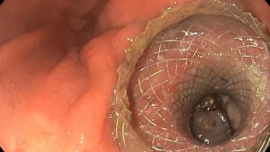 Cecal sessile polyp (LST-G) – GastroCloud