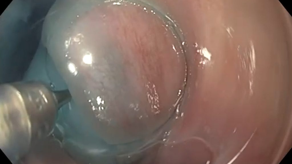 Hemostasis using the endo-loop – GastroCloud